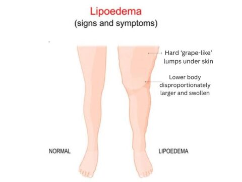 Lipedema Explained – Causes, Symptoms & Natural Treatment in Brisbane